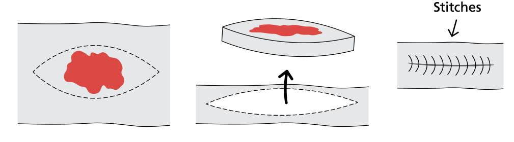 Suspicious Mole? Private vs NHS: What Happens and How Fast