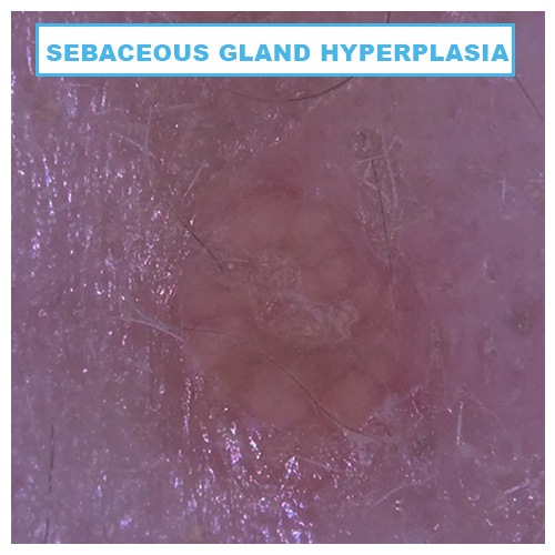 I have a spot or bump on the nose - what could it be? - Midland Skin