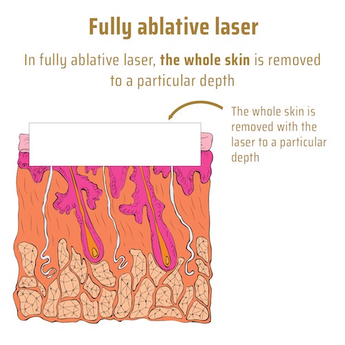 Fully ablative CO2 laser resurfacing - Dermatologists Birmingham