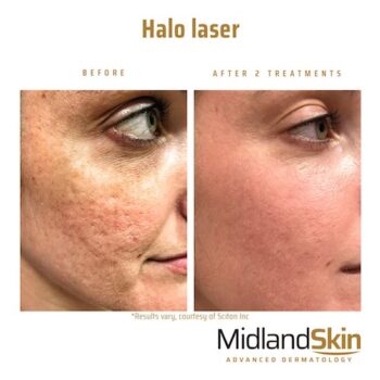 Halo laser - Midland Skin