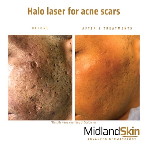 Halo laser - Midland Skin