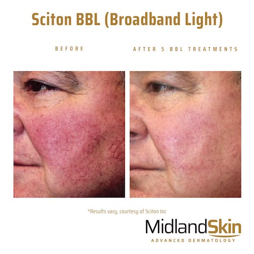 BBL (Broadband light) - Midland Skin