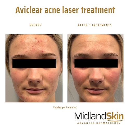 Aviclear Acne Laser treatment - Dermatologists Birmingham - Midland Skin