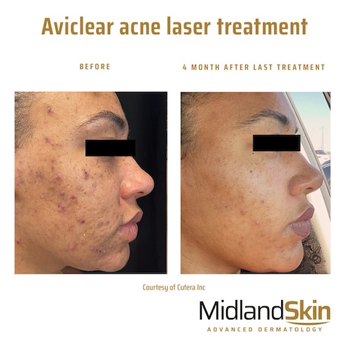 Aviclear Acne Laser treatment - Dermatologists Birmingham - Midland Skin