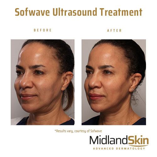 Sofwave for lines, wrinkles, lift & acne scars - Dermatologists Birmingham