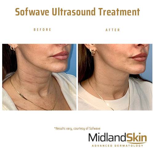 Sofwave for lines, wrinkles, lift & acne scars - Dermatologists Birmingham