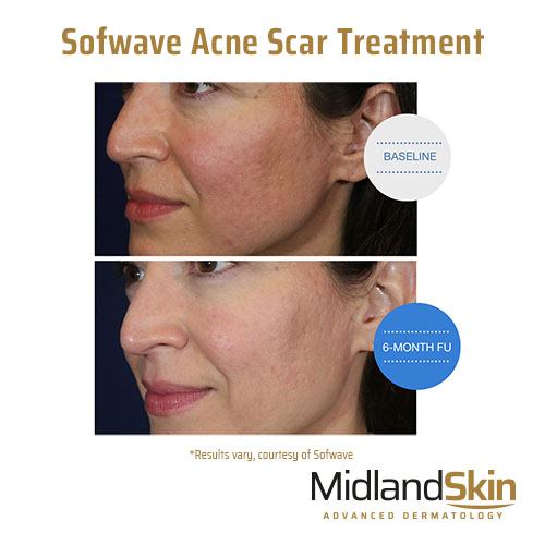 Sofwave for lines, wrinkles, lift & acne scars - Dermatologists Birmingham