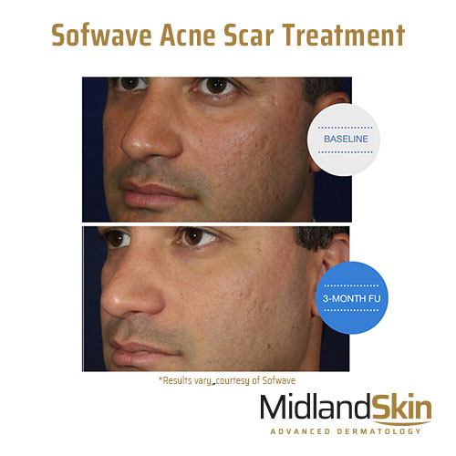 Sofwave for lines, wrinkles, lift & acne scars - Dermatologists Birmingham