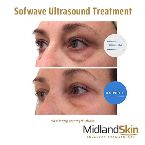Sofwave for lines, wrinkles, lift & acne scars - Dermatologists Birmingham