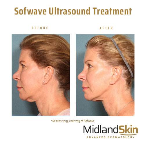 Sofwave for lines, wrinkles, lift & acne scars - Dermatologists Birmingham
