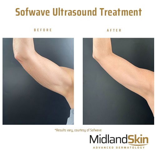 Sofwave for lines, wrinkles, lift & acne scars - Dermatologists Birmingham