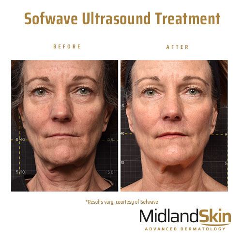 Sofwave for lines, wrinkles, lift & acne scars - Dermatologists Birmingham