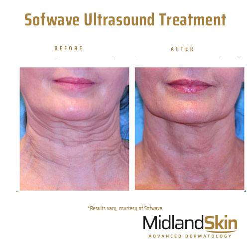 Sofwave for lines, wrinkles, lift & acne scars - Dermatologists Birmingham
