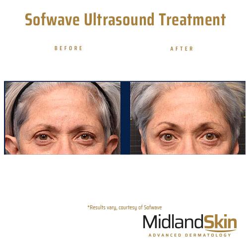 Sofwave for lines, wrinkles, lift & acne scars - Dermatologists Birmingham
