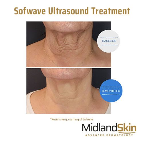 Sofwave for lines, wrinkles, lift & acne scars - Dermatologists Birmingham