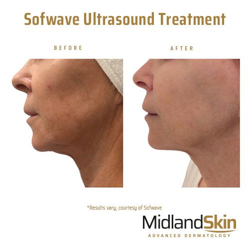 Sofwave for lines, wrinkles, lift & acne scars - Dermatologists Birmingham