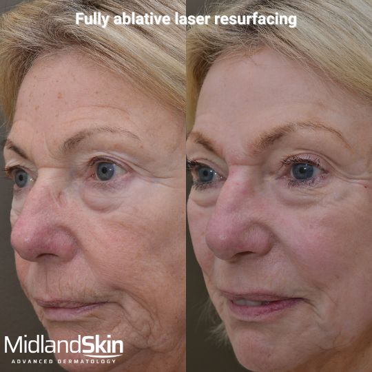 Fully ablative CO2 laser resurfacing - Dermatologists Birmingham