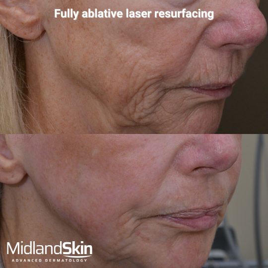 Fully ablative CO2 laser resurfacing - Dermatologists Birmingham