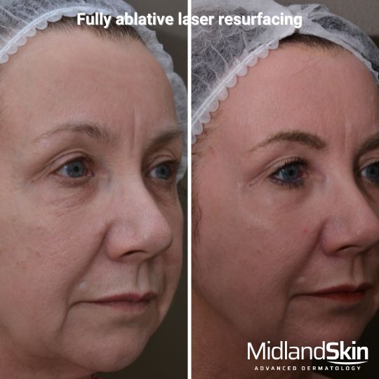 Fully ablative CO2 laser resurfacing - Dermatologists Birmingham