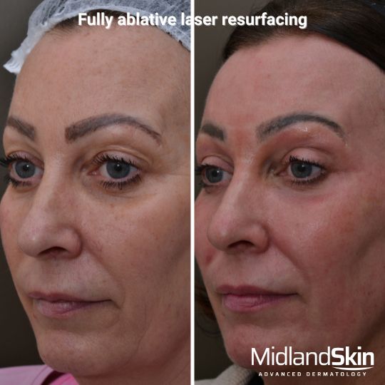 Fully ablative CO2 laser resurfacing - Dermatologists Birmingham