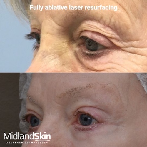 Fully ablative CO2 laser resurfacing - Dermatologists Birmingham